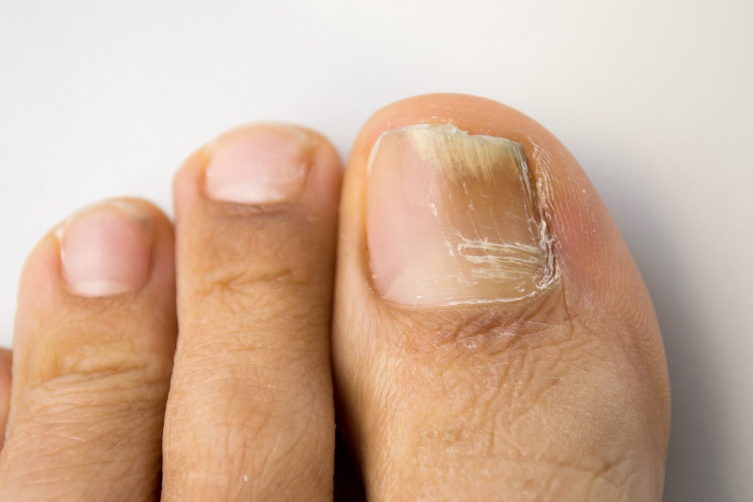 Types & Stages of Toenail Fungus | Rocky Mountain Orthopedics of Utah