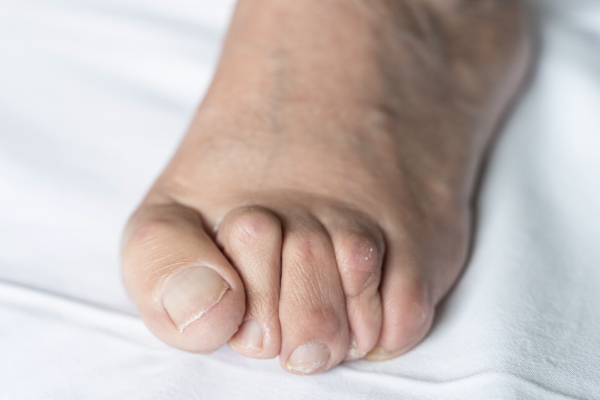 5 Common Types of Foot Surgery | Rocky Mountain Orthopedics of Utah