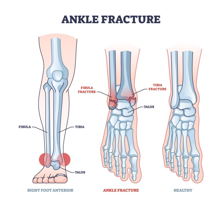 Sprained Ankle vs Broken Ankle | Rocky Mountain Orthopedics of Utah