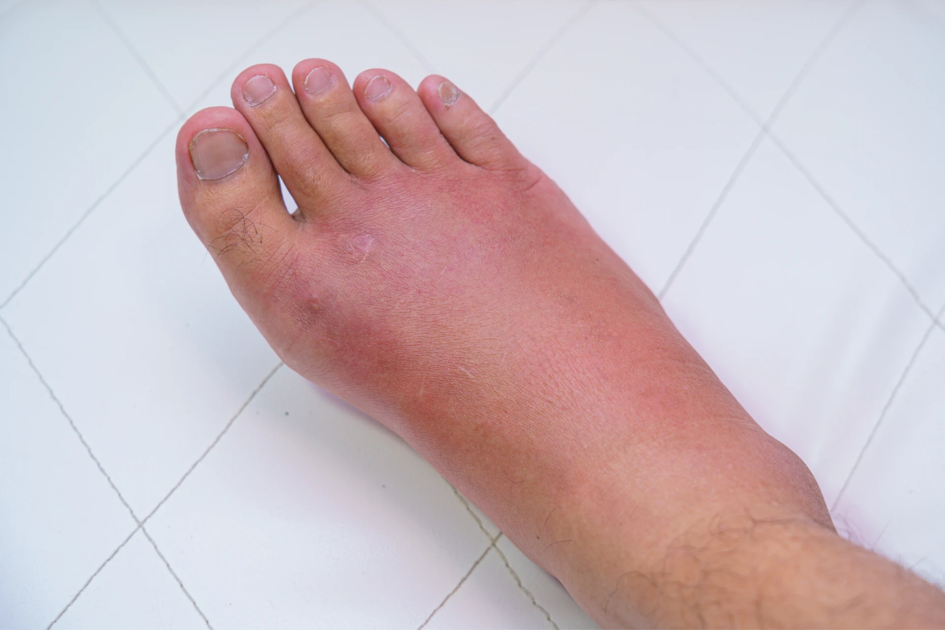 Charcot Foot Signs