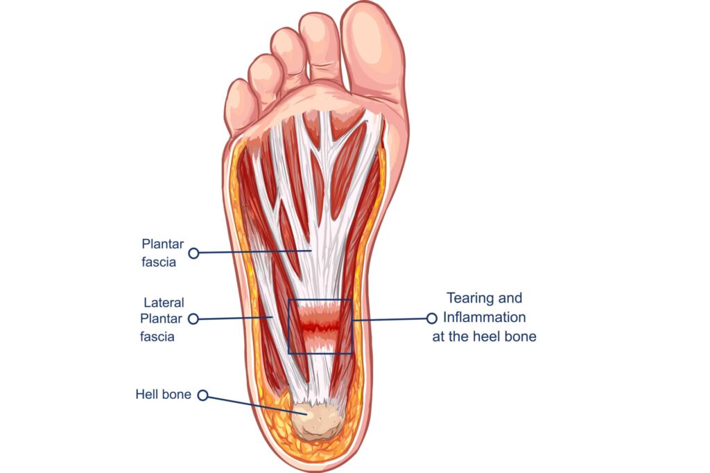 Plantar Fasciitis Relief Options Rocky Mountain Orthopedics Of Utah